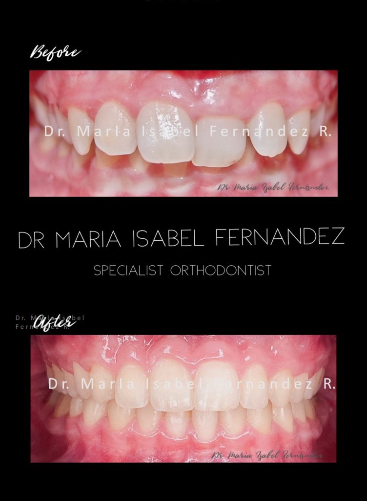 WHAT IS A DEEP BITE? - Smile Studios - Best Medical Center in Bahrain & GCC